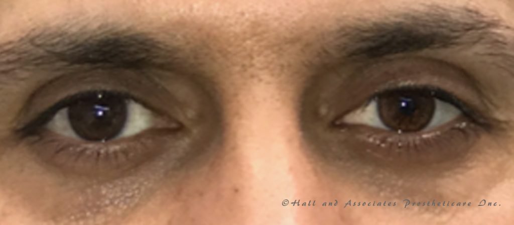 Artificial Eye Prosthetic Care and Cleaning - Hall & Associates ...
