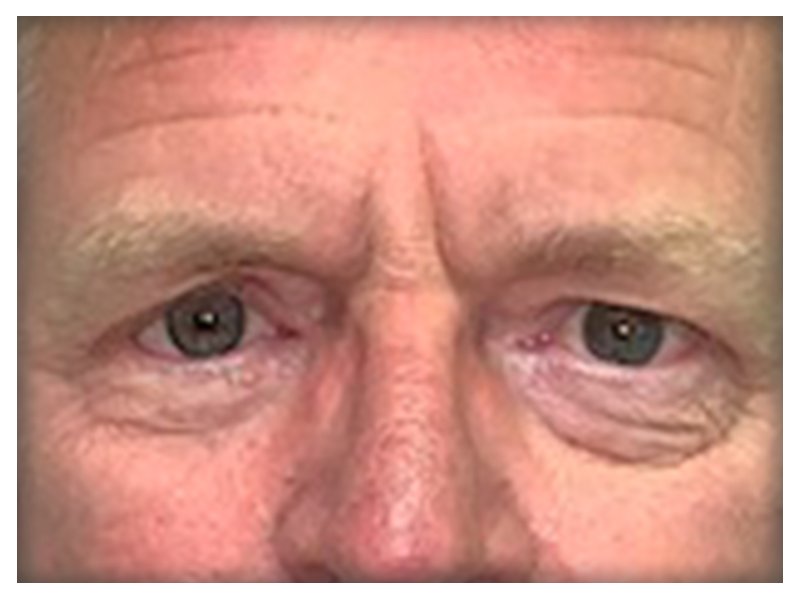 Before & After Toronto Eye Prosthetic Image Gallery - Hall & Associates ...