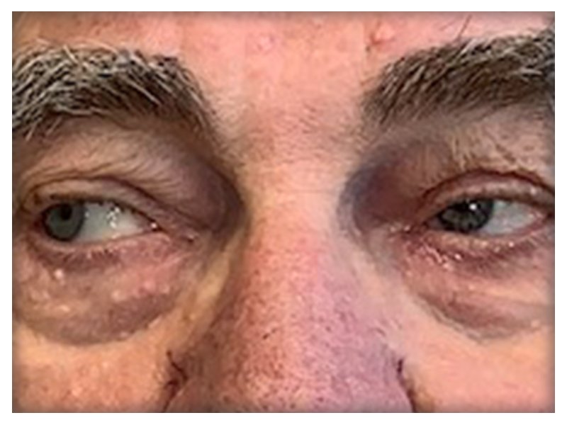 Before & After Toronto Eye Prosthetic Image Gallery - Hall & Associates ...