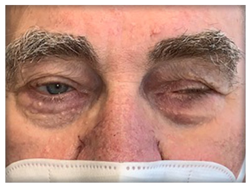 Before & After Toronto Eye Prosthetic Image Gallery - Hall & Associates ...