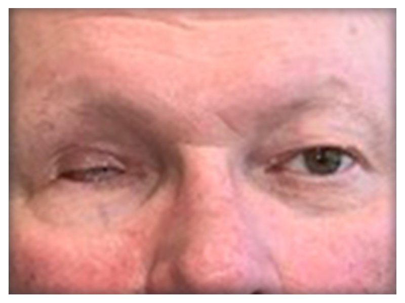 Before & After Toronto Eye Prosthetic Image Gallery - Hall & Associates ...